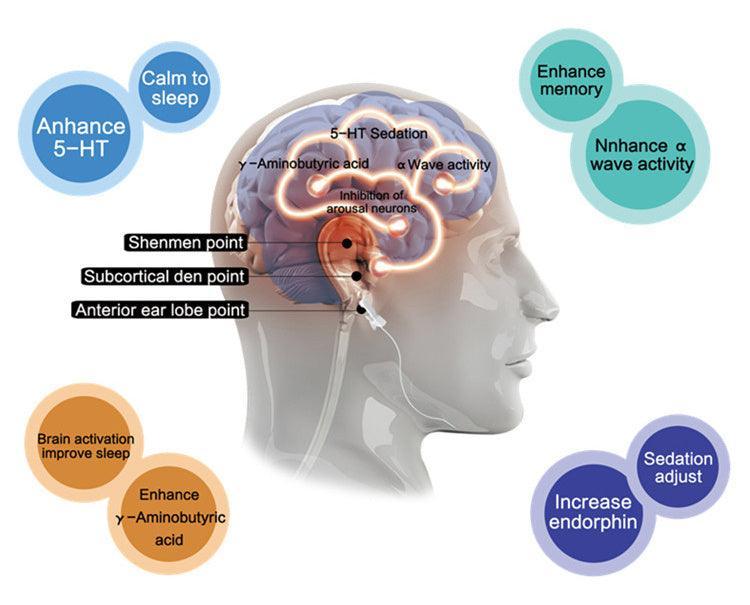 Insomnia device improves sleep artifact and helps sleep – NaturalSleep.shop